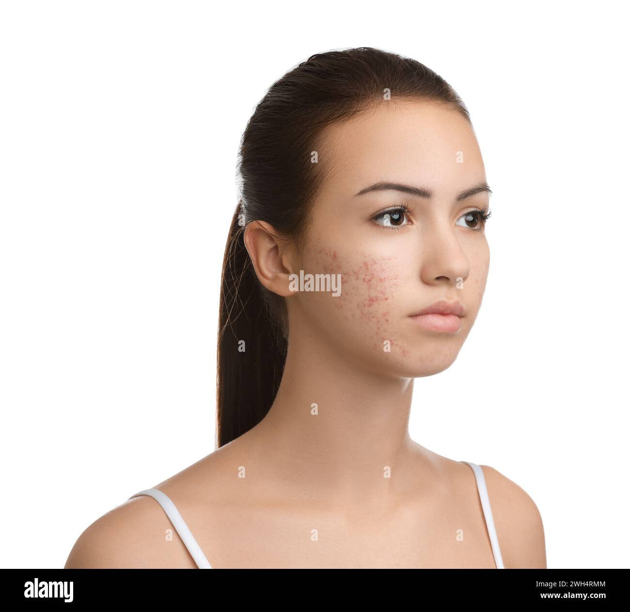 Teenage girl with acne problem on white background Stock Photo - Alamy