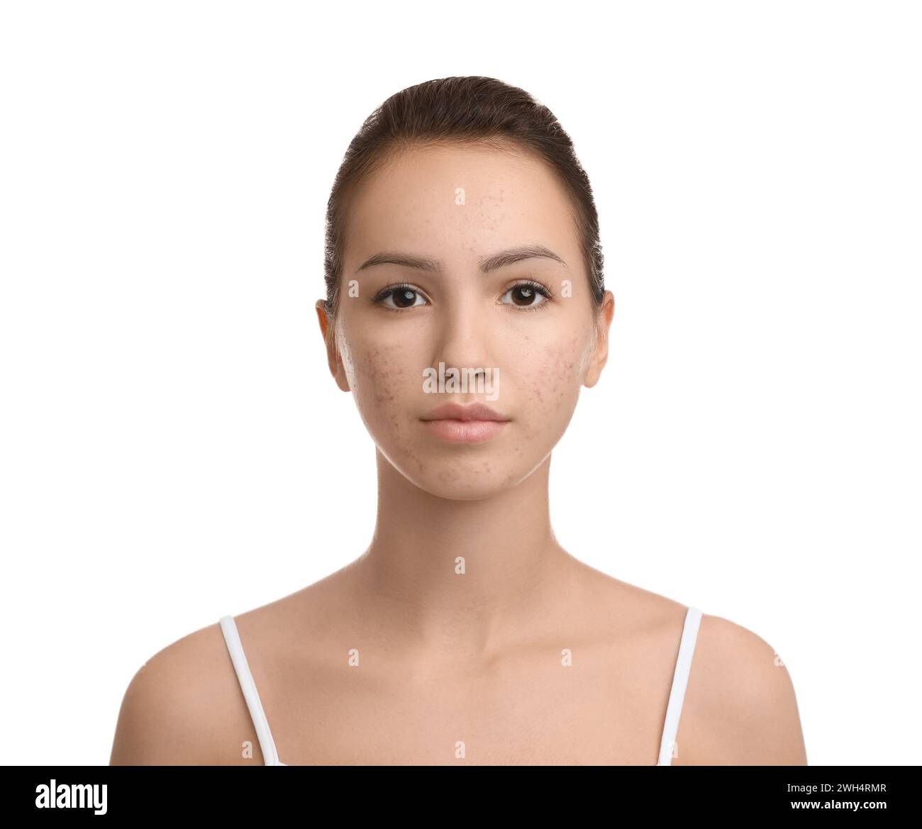 Teenage girl with acne problem on white background Stock Photo - Alamy