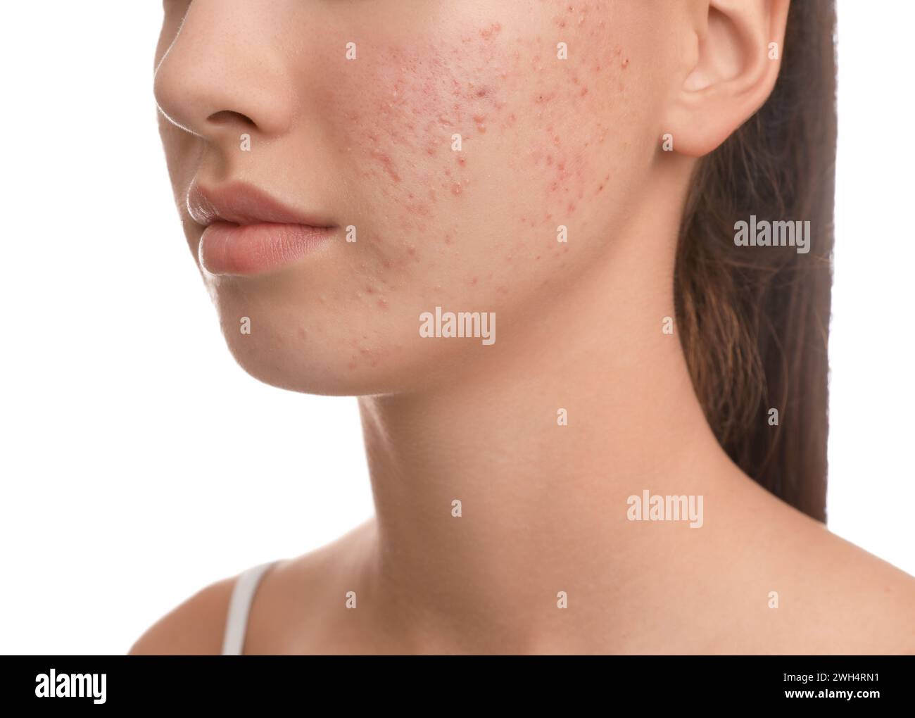 Teenage girl with acne problem on white background, closeup Stock Photo ...