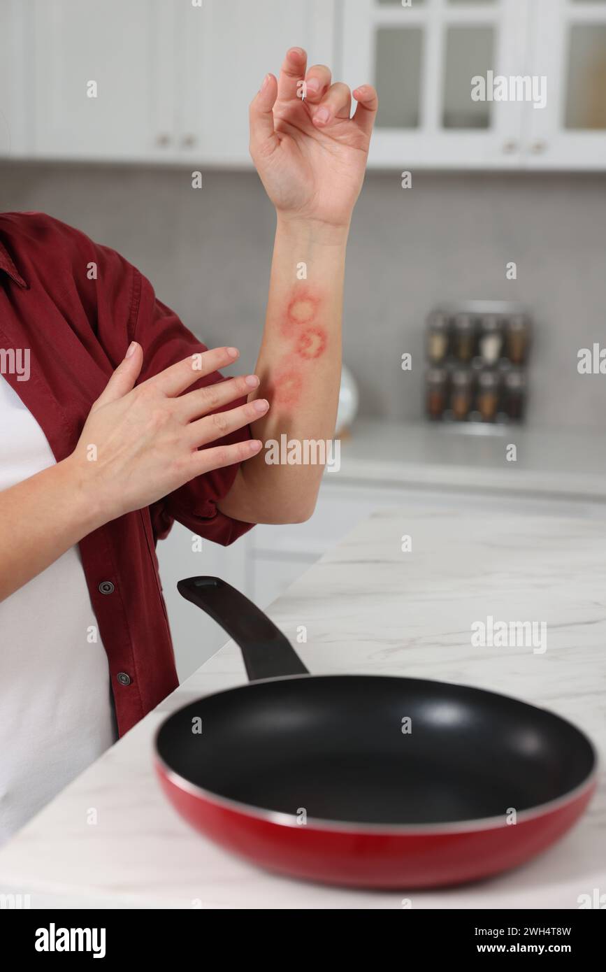 Burn mark on hand hi-res stock photography and images - Alamy