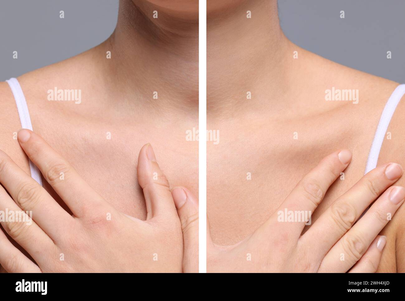 Aging skin changes. Woman showing neck before and after rejuvenation ...
