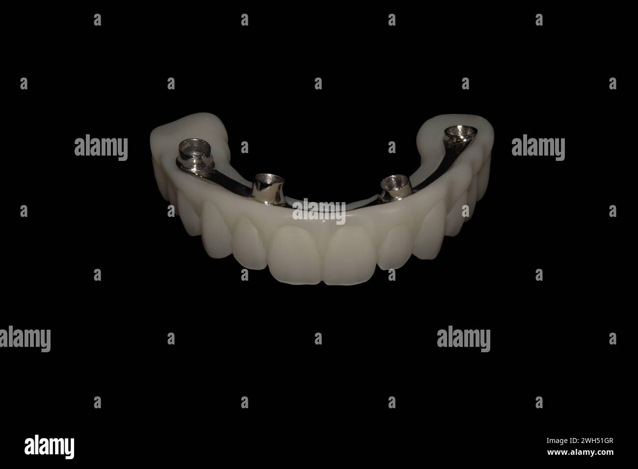 Hybrid Prosthesis: Dental Implants with Metal Bar and 3D-Printed ...