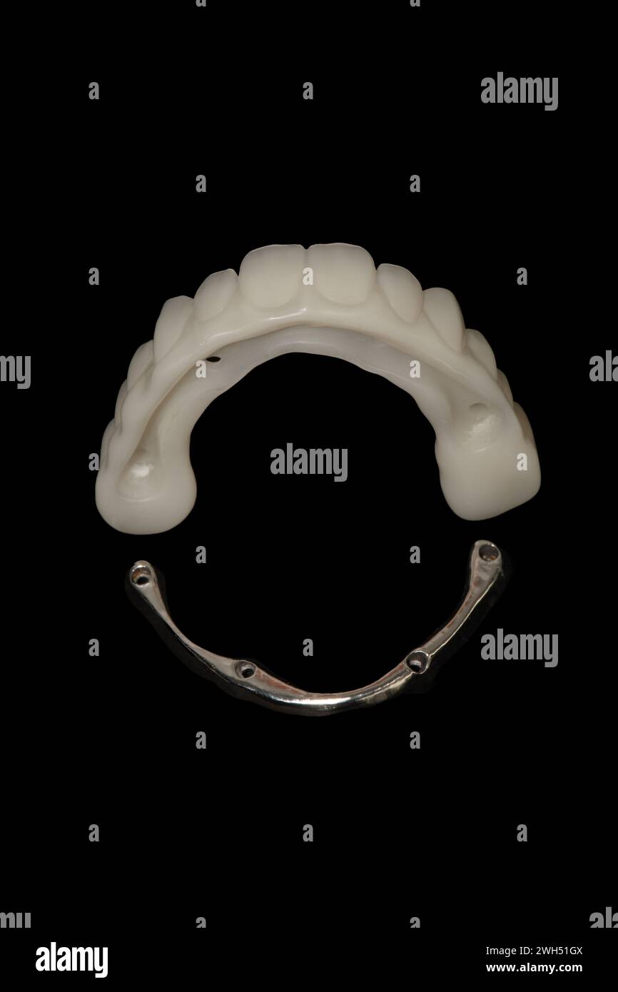 Hybrid Prosthesis: Dental Implants with Metal Bar and 3D-Printed ...