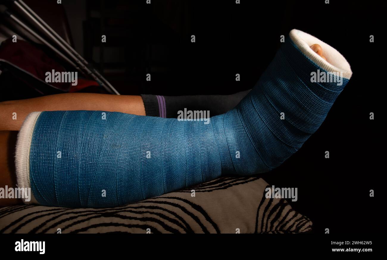 Limb cast hi-res stock photography and images - Alamy