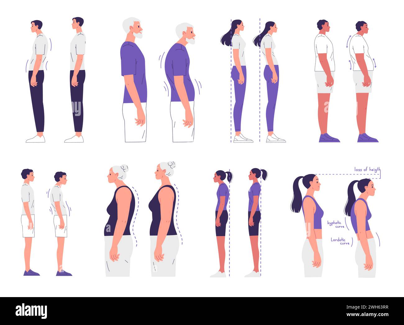 People with correct and incorrect posture. Scoliosis, curvature of the ...