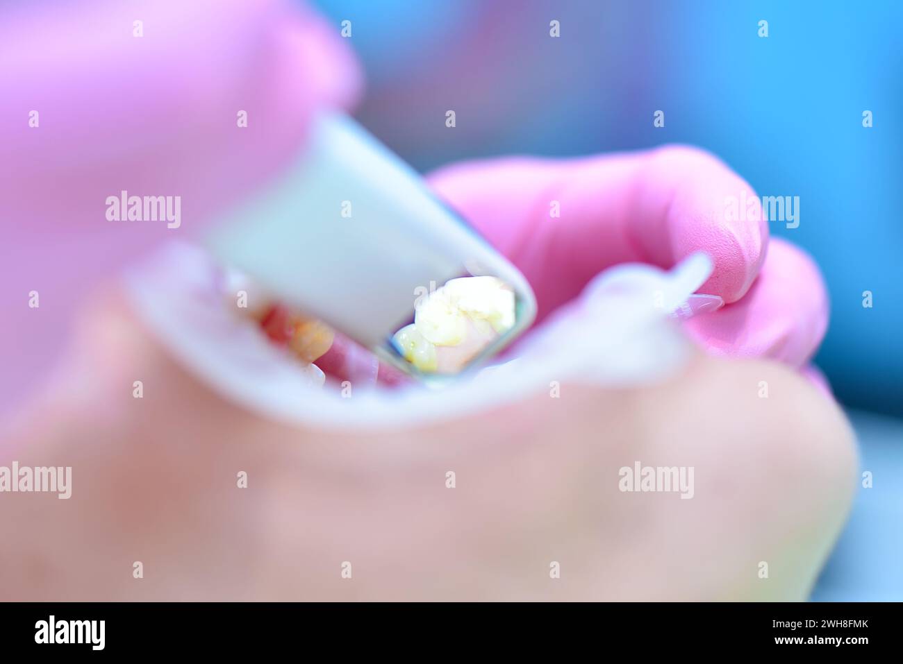 Close up of dentist doing 3d scanning of patients teeth. Checkup and ...