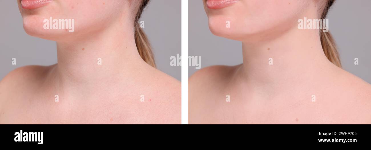 Aging skin changes. Woman showing neck before and after rejuvenation ...