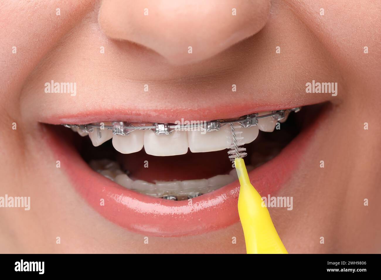 Woman with dental braces cleaning teeth using interdental brush ...