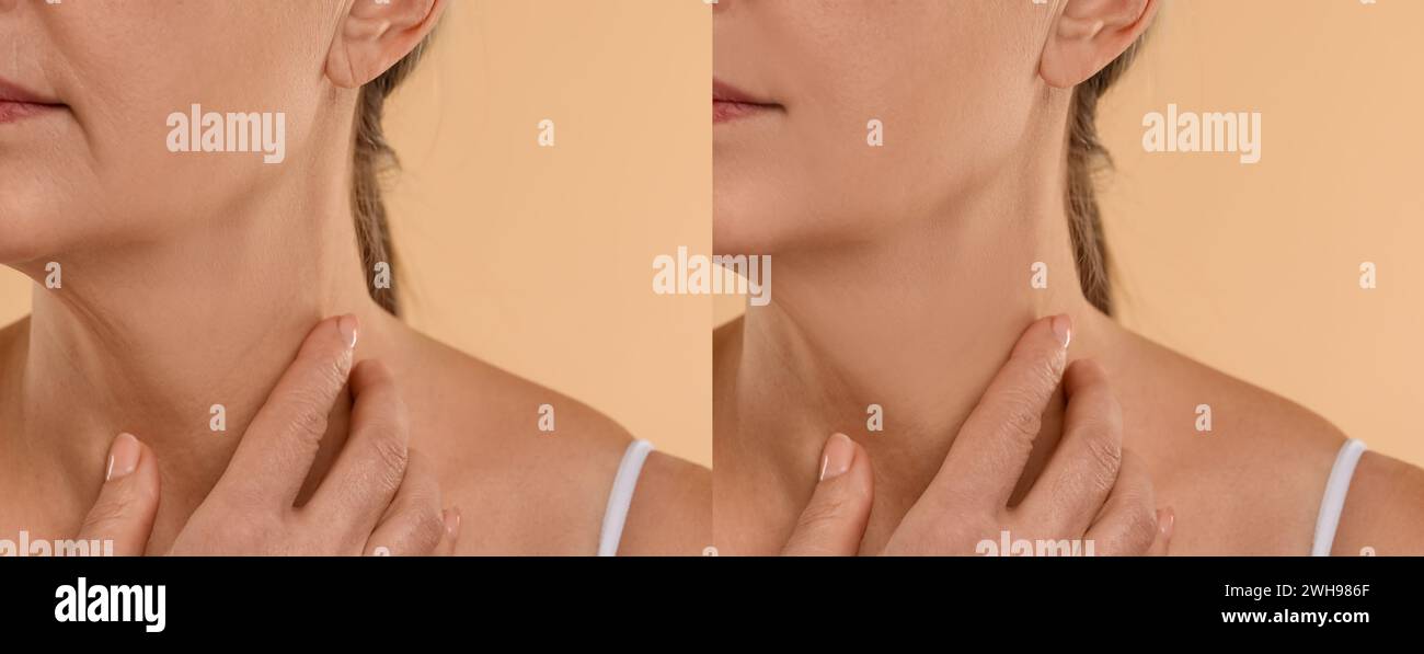Aging skin changes. Woman showing neck before and after rejuvenation ...