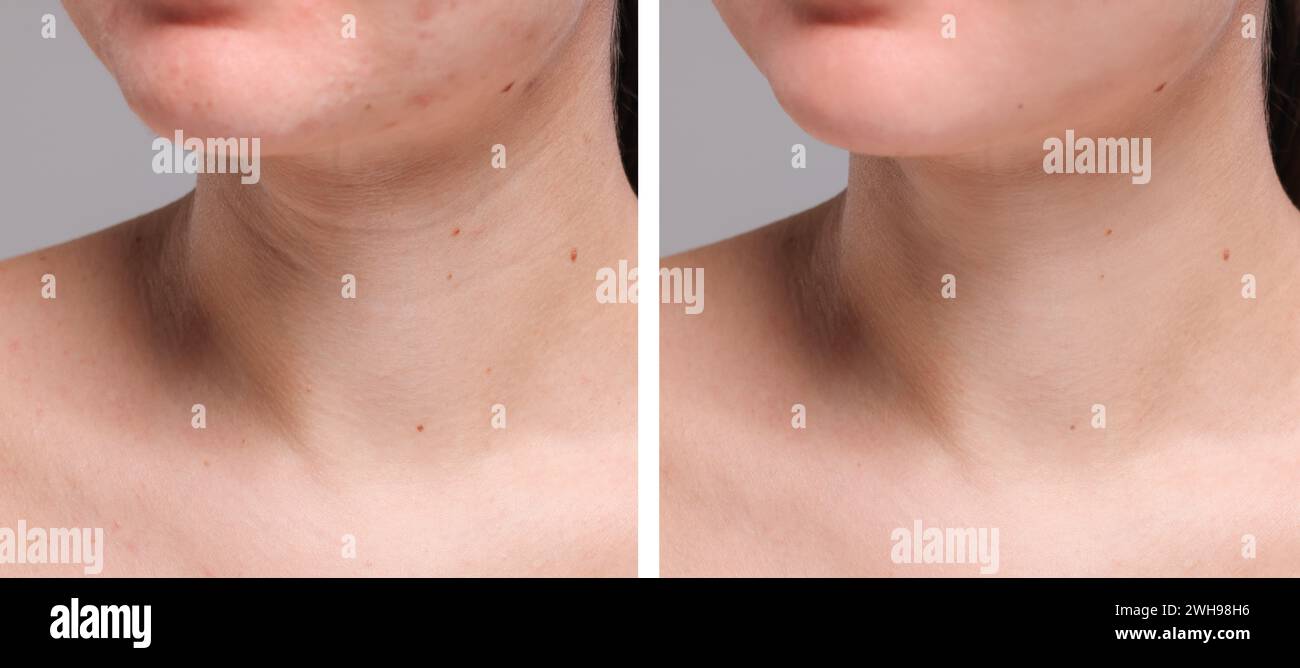 Aging skin changes. Woman showing neck before and after rejuvenation ...