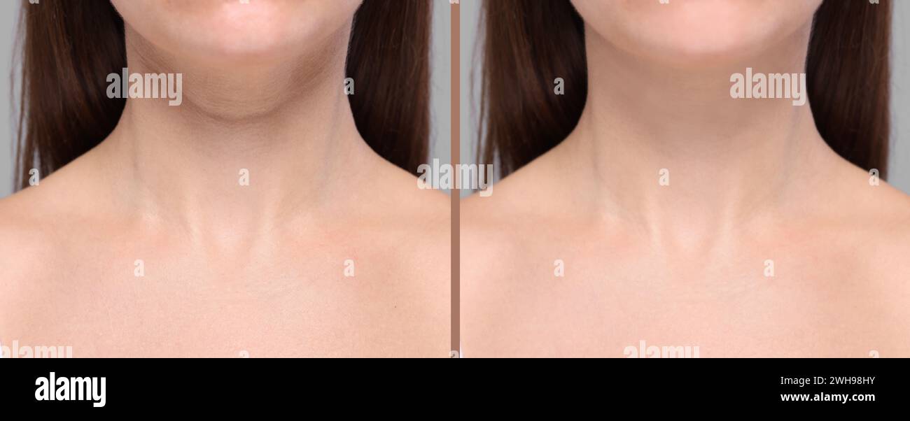 Aging skin changes. Woman showing neck before and after rejuvenation ...