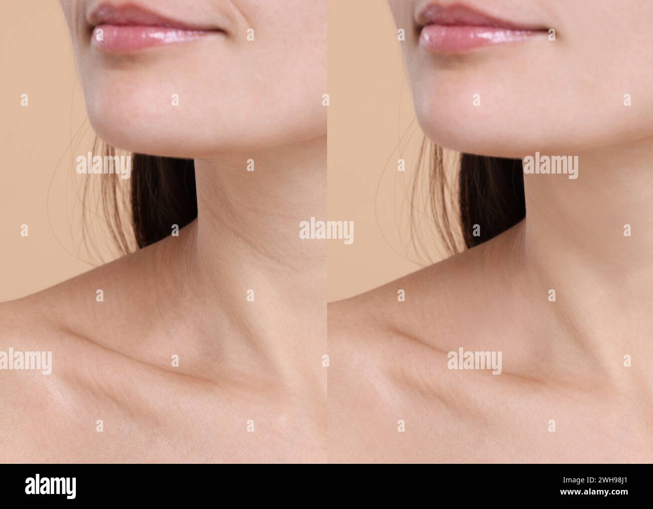 Aging skin changes. Woman showing neck before and after rejuvenation ...