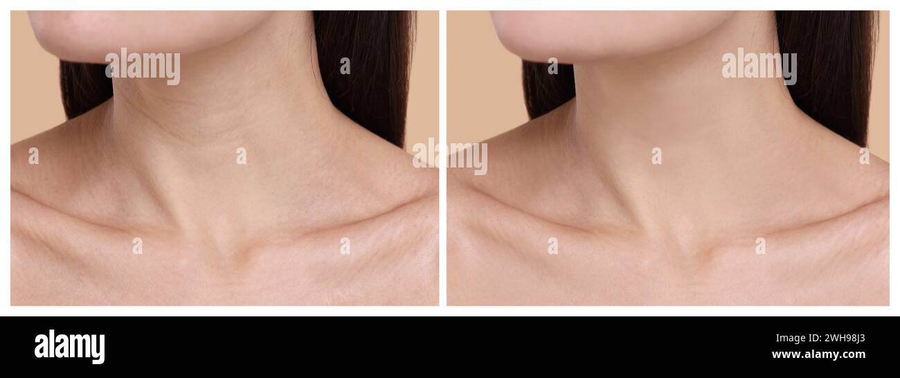 Aging skin changes. Woman showing neck before and after rejuvenation ...