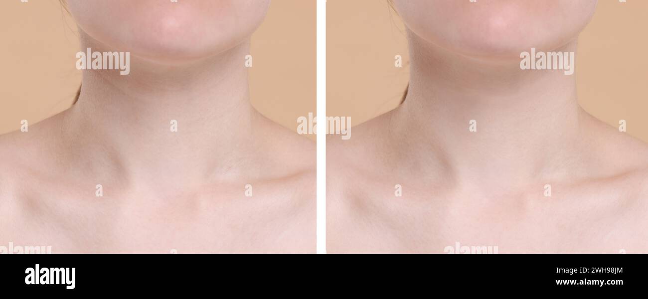 Aging skin changes. Woman showing neck before and after rejuvenation ...