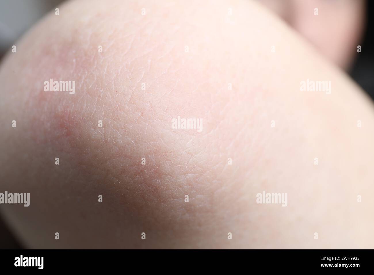 Woman with dry skin on elbow, closeup Stock Photo - Alamy
