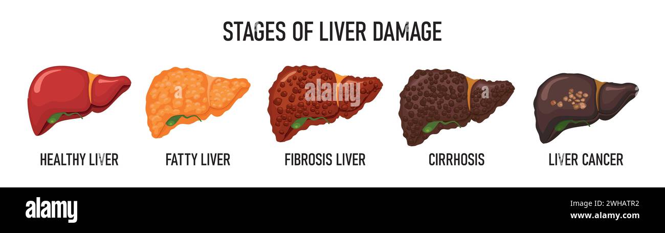 Stages of liver destruction Stock Vector Image & Art - Alamy