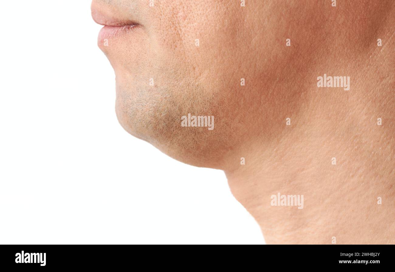 Man a double fat chin, a problem with a hanging chin with white ...