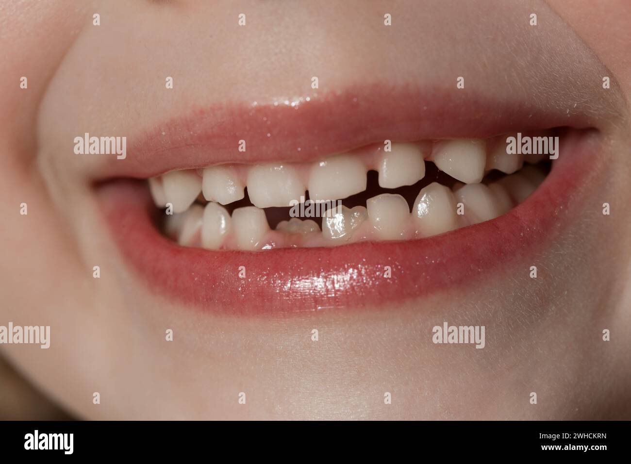 Cute preschool girl showing a loose primary (baby) tooth Stock Photo ...