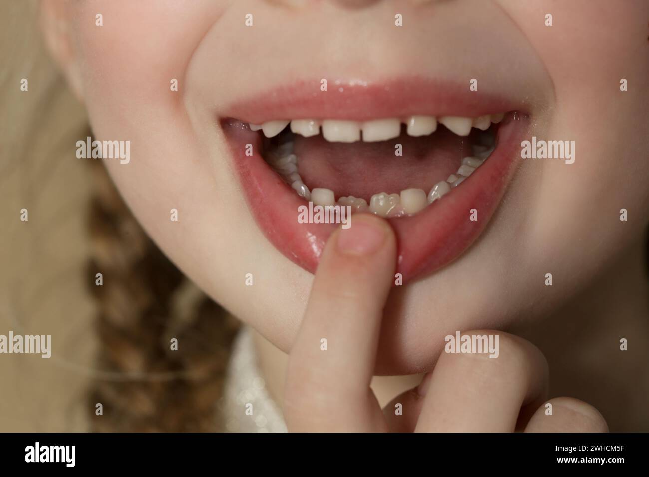 Cute preschool girl showing a loose primary (baby) tooth Stock Photo ...