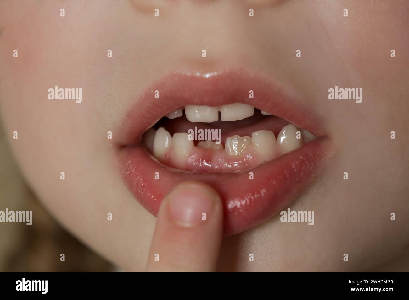 Cute preschool girl showing a loose primary (baby) tooth Stock Photo ...