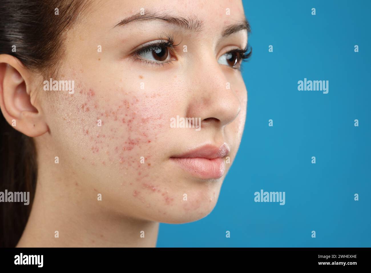 Teenage girl with acne problem on blue background, closeup Stock Photo ...