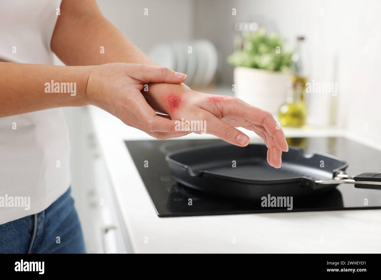 Burn mark on hand hi-res stock photography and images - Alamy
