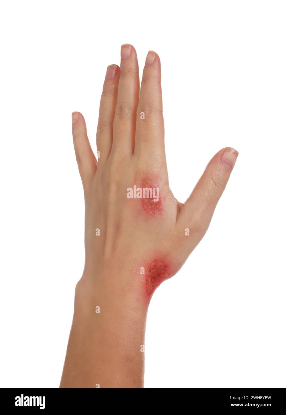 Burn mark on hand hi-res stock photography and images - Alamy