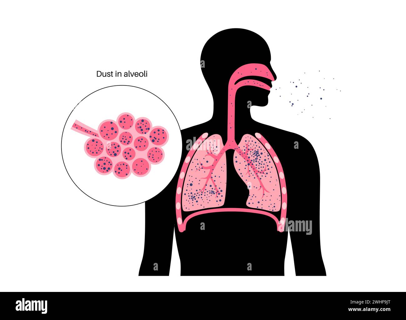 Pneumoconiosis lung disease, illustration Stock Photo - Alamy