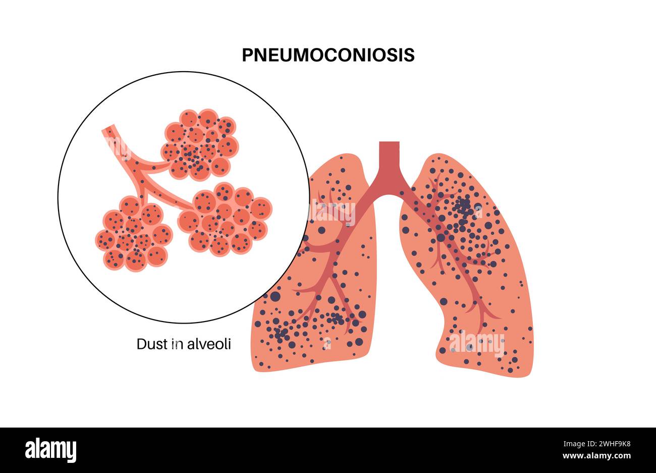 Pneumoconiosis lung disease, illustration Stock Photo - Alamy