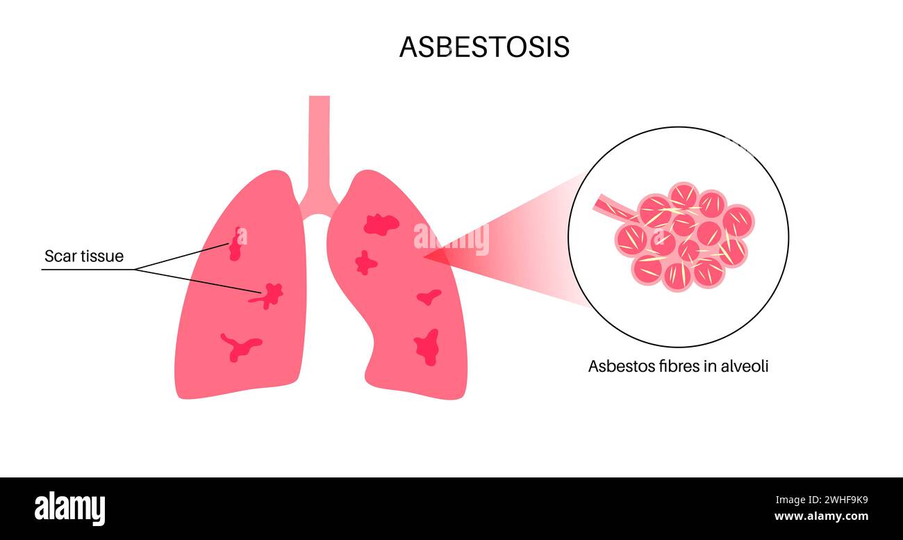 Asbestosis lung disease, illustration Stock Photo - Alamy