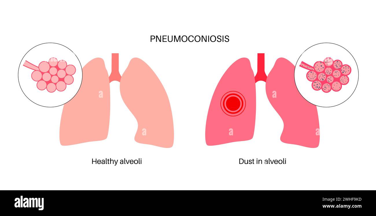 Pneumoconiosis lung disease, illustration Stock Photo - Alamy