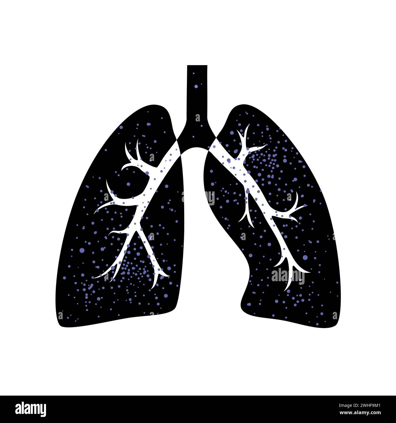 Pneumoconiosis lung disease, illustration Stock Photo - Alamy