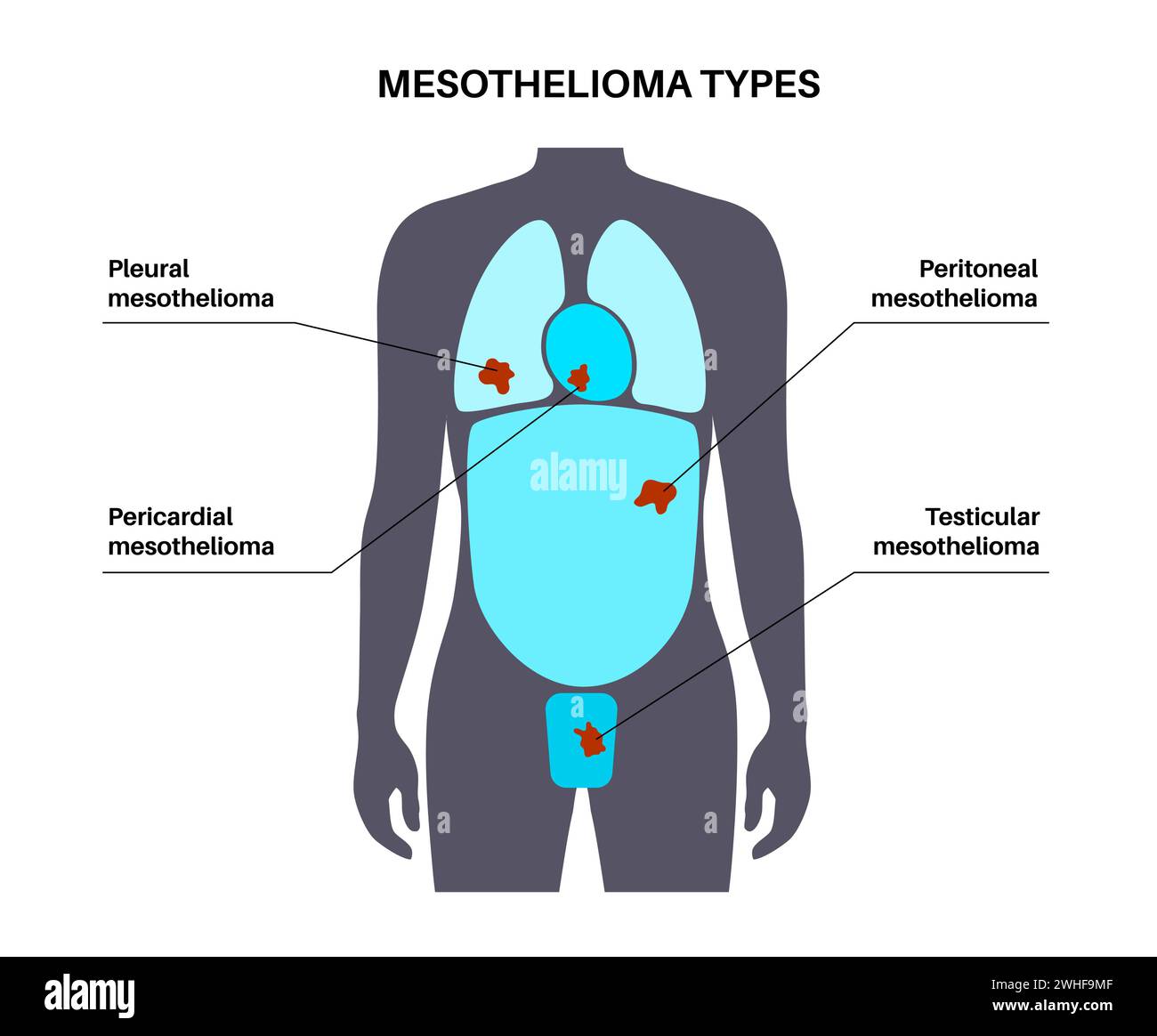 Mesothelioma tumour types, illustration Stock Photo - Alamy Mesothelioma tumour types, illustration Stock Photo - Alamy