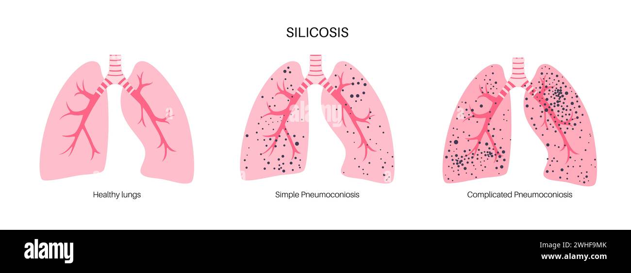 Silicosis dust in lung, illustration Stock Photo - Alamy