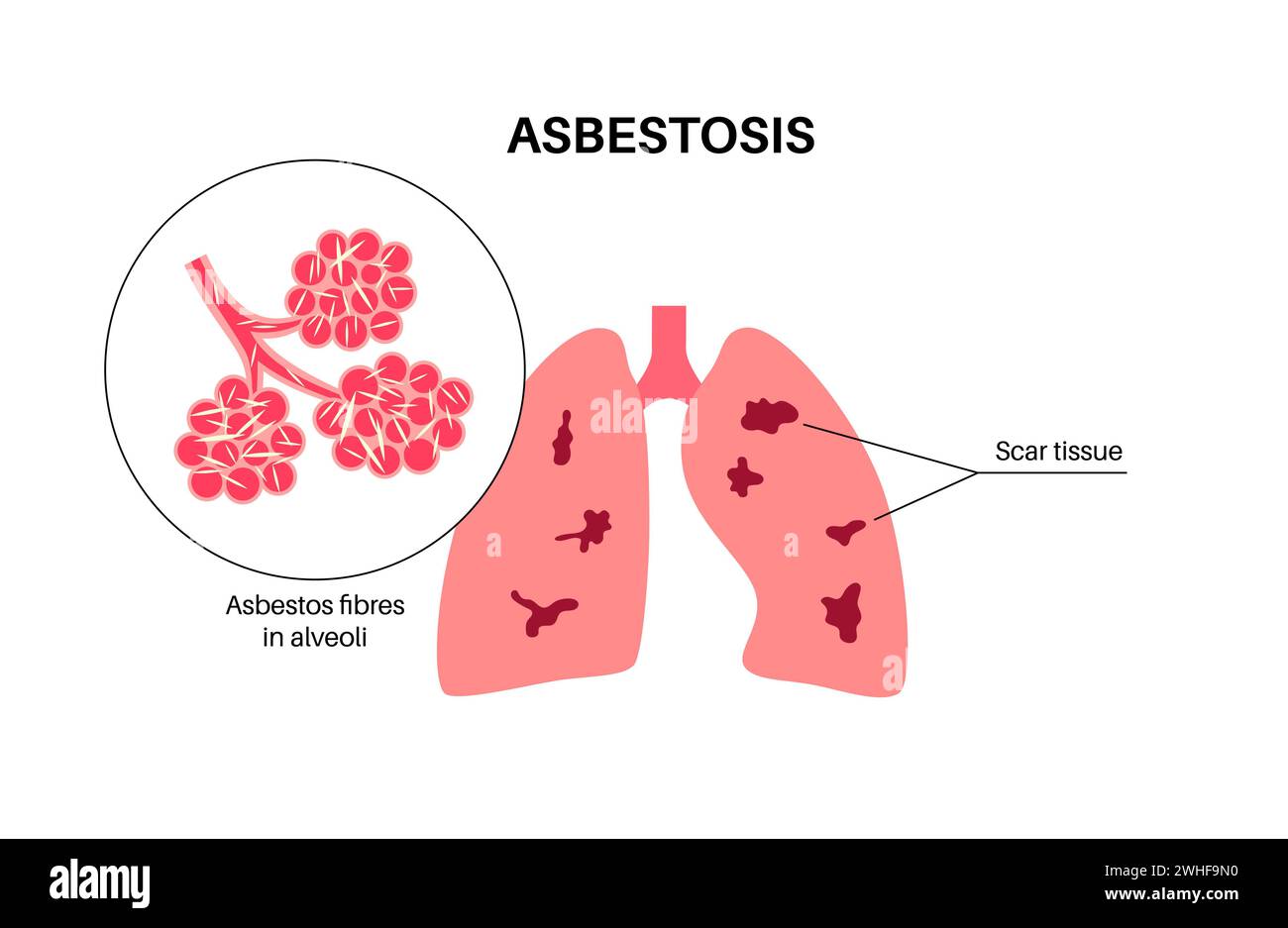 Asbestosis lung disease, illustration Stock Photo - Alamy