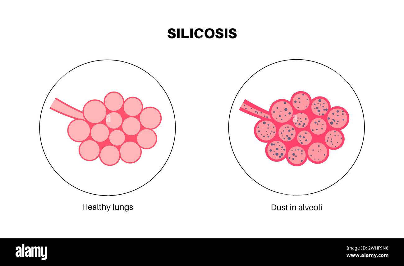 Silicosis dust in lung, illustration Stock Photo - Alamy