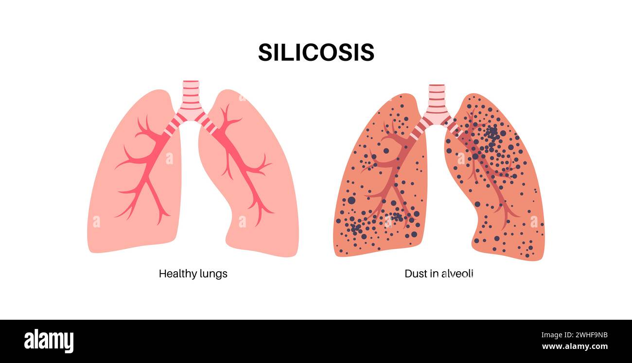 Silicosis dust in lung, illustration Stock Photo - Alamy