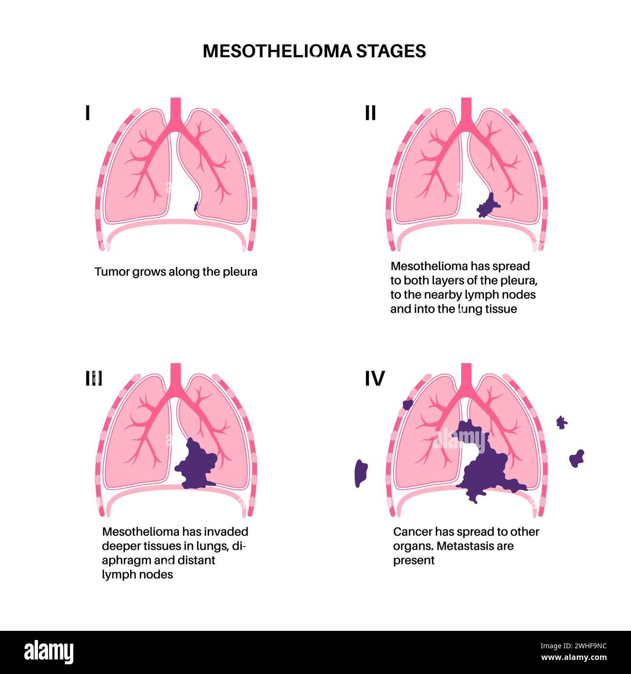 Pleural cancer hi-res stock photography and images - Alamy
