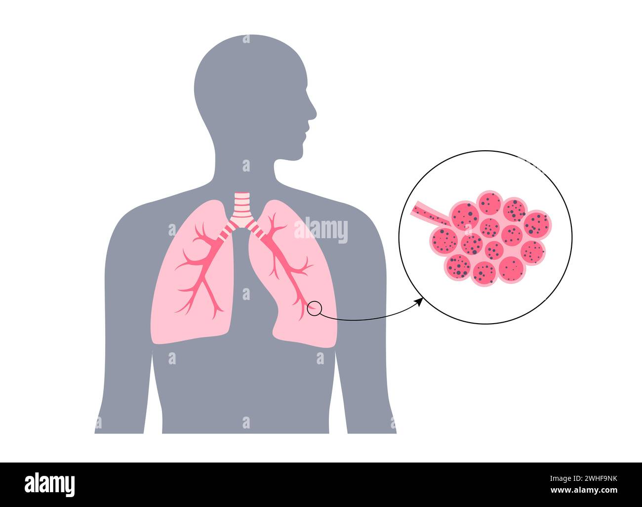 Pneumoconiosis lung disease, illustration Stock Photo - Alamy