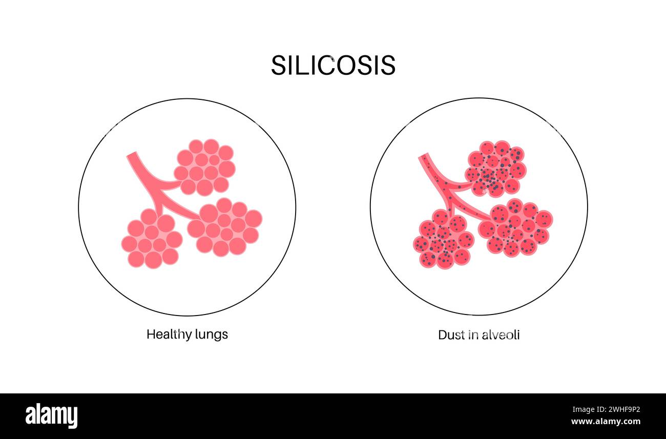 Silicosis dust in lung, illustration Stock Photo - Alamy