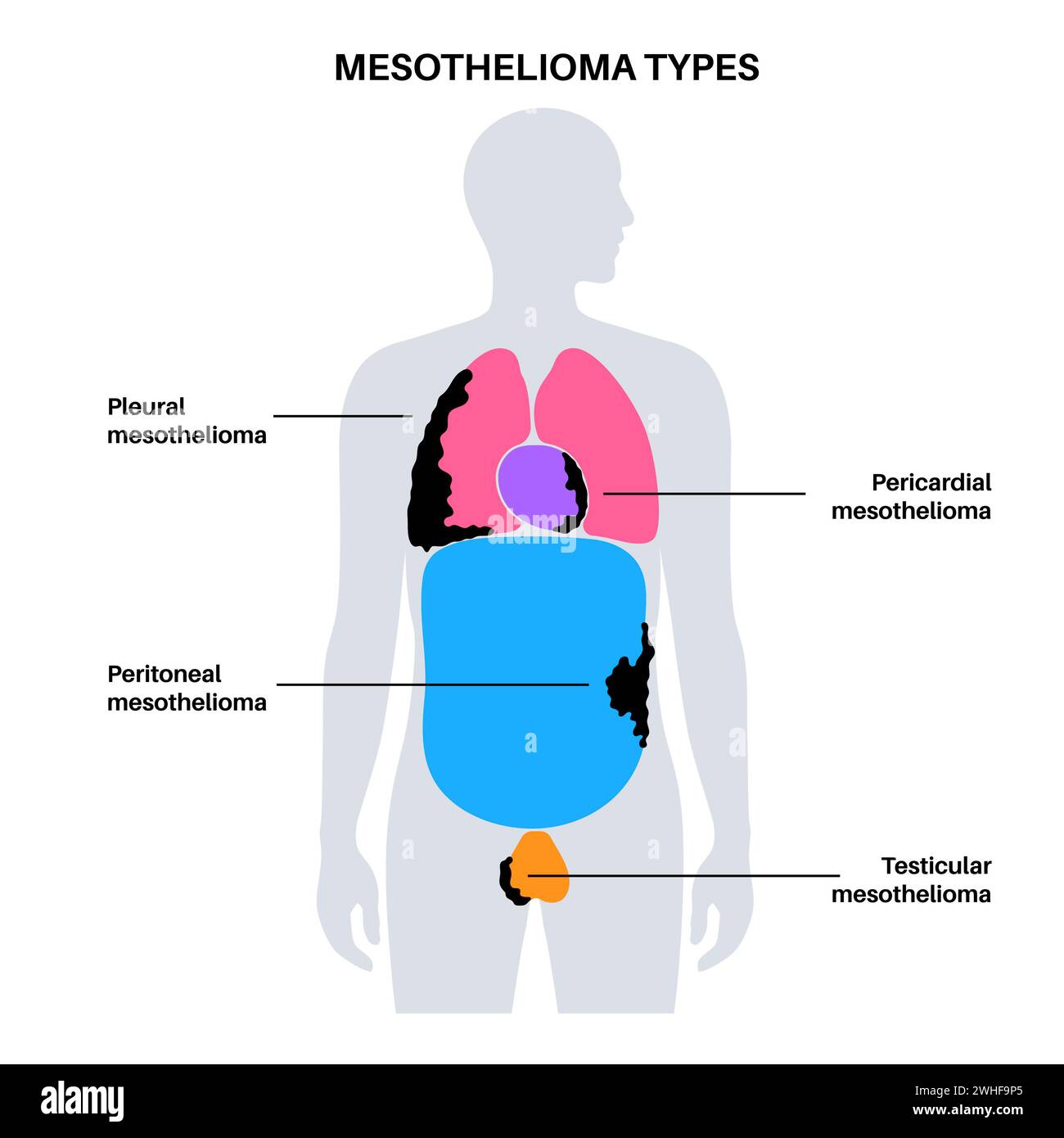 Peritoneal hi-res stock photography and images - Alamy