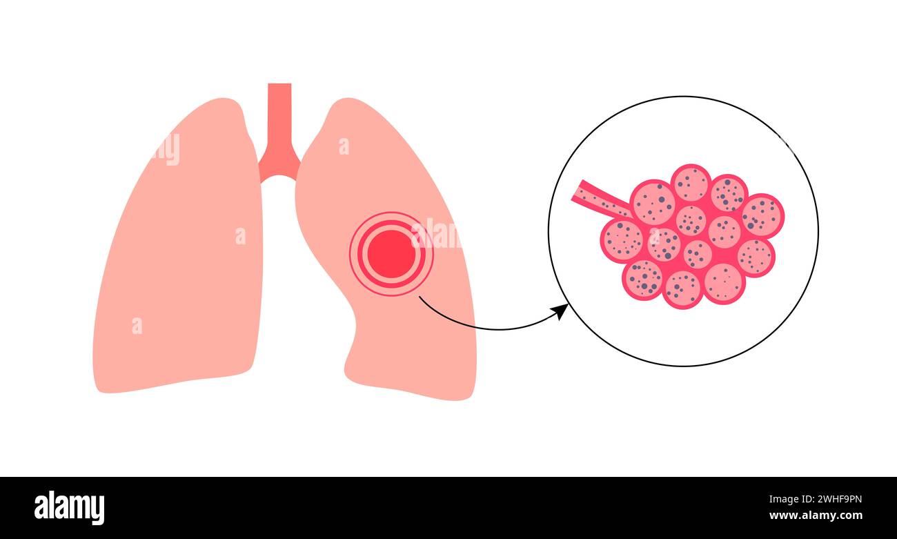 Pneumoconiosis lung disease, illustration Stock Photo - Alamy