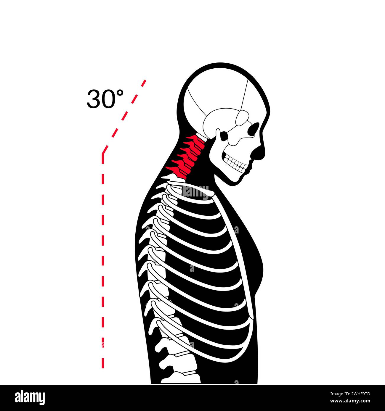 Cervical vertebra deformity hi-res stock photography and images - Alamy