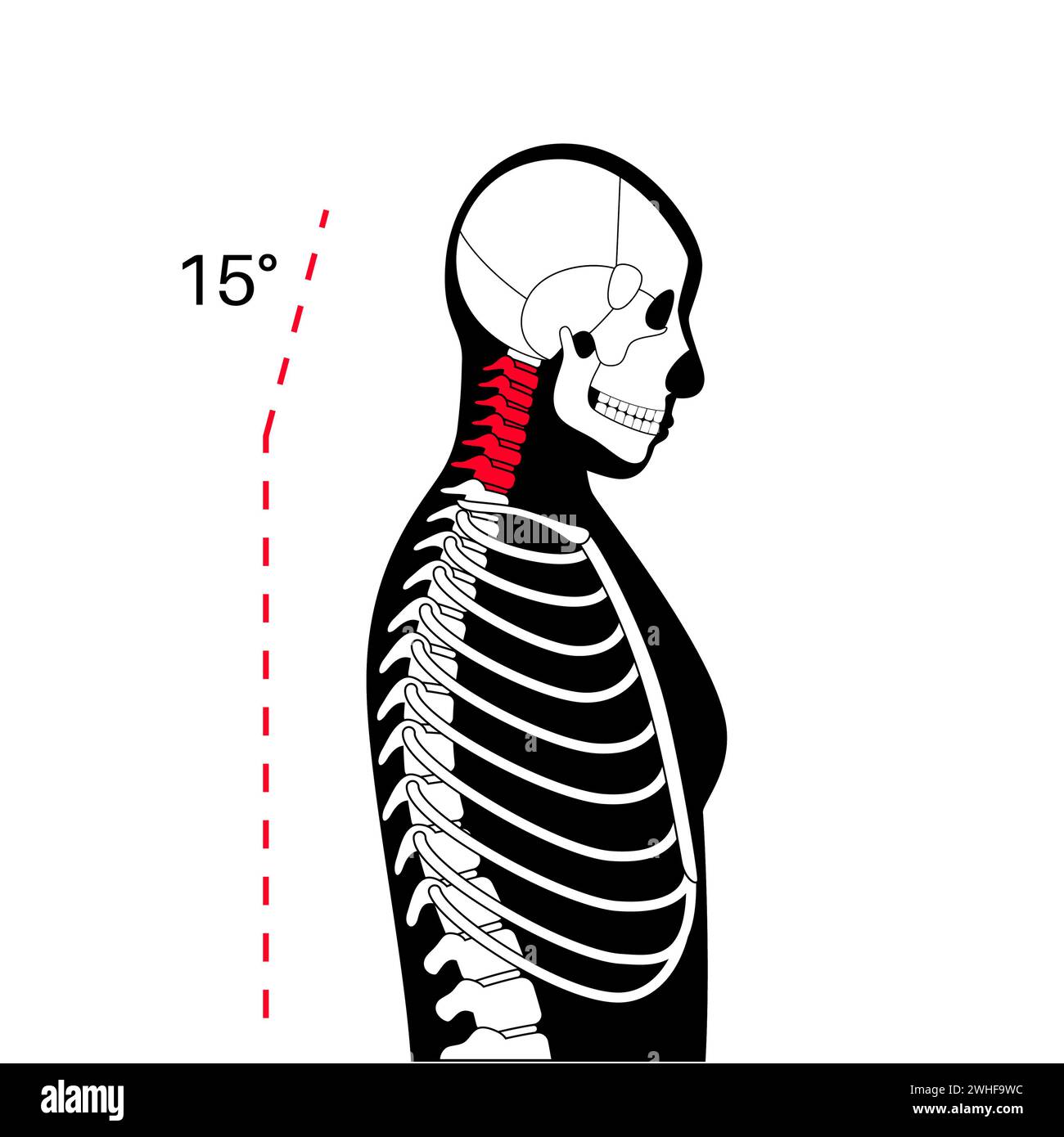 Neck vertebrae deformity, illustration Stock Photo - Alamy