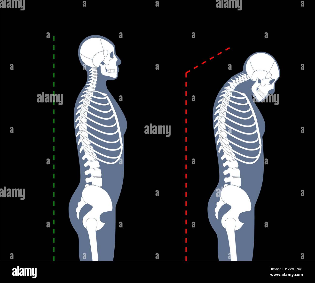 Cervical vertebra deformity hi-res stock photography and images - Alamy