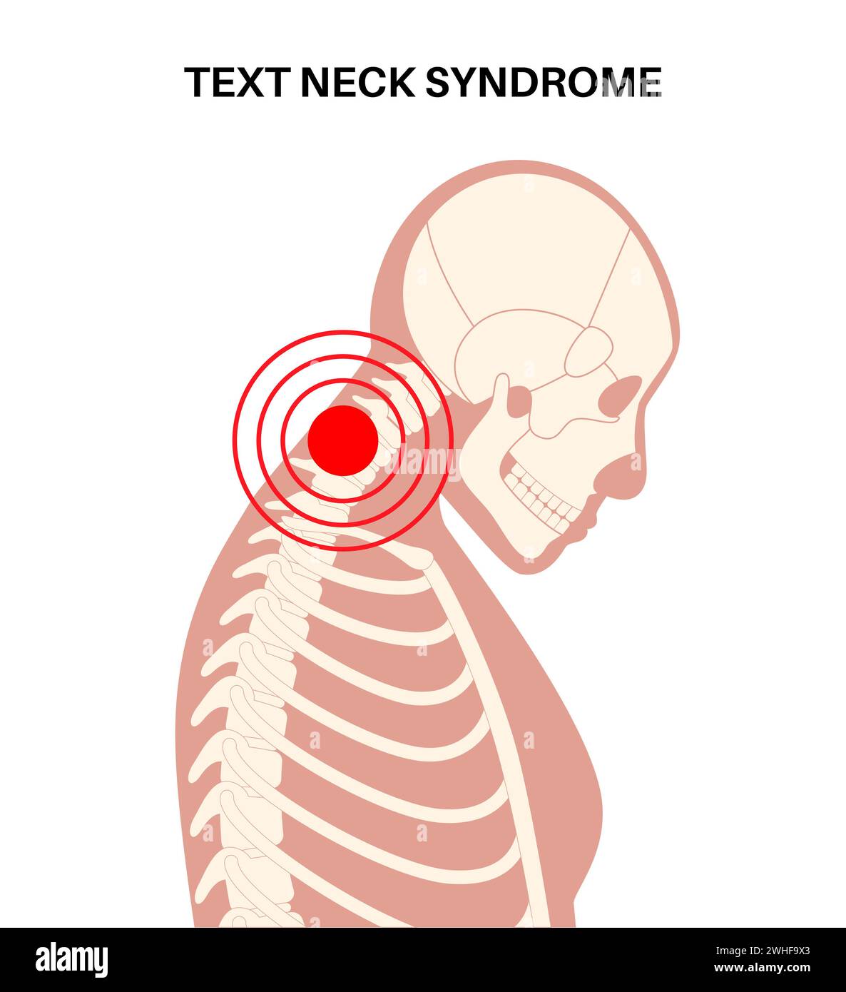 Cervical vertebra deformity hi-res stock photography and images - Alamy