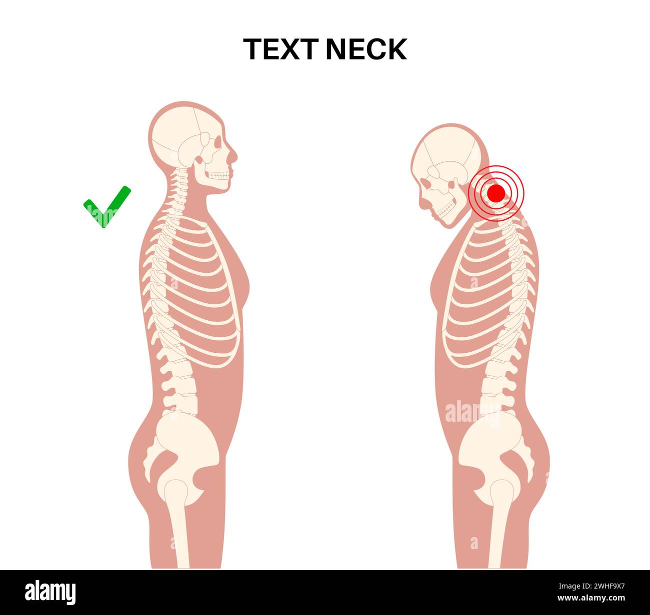 Neck vertebrae deformity, illustration Stock Photo - Alamy