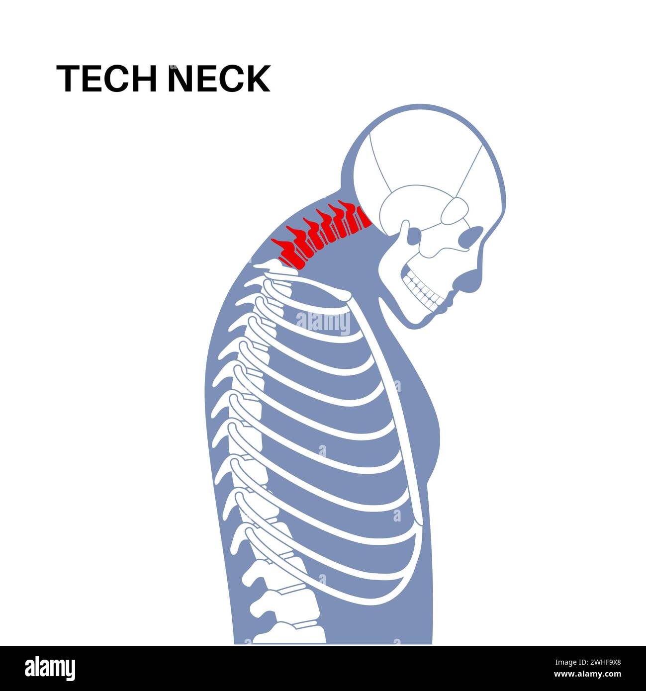 Neck vertebrae deformity, illustration Stock Photo - Alamy