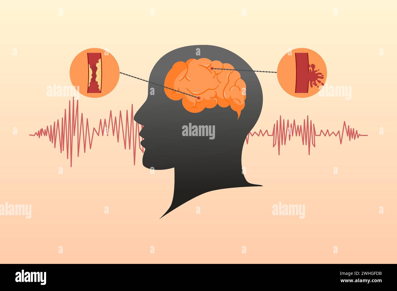 Stroke disease concept. Ischemic and hemorrhagic. Scientific medical illustration of human brain ...