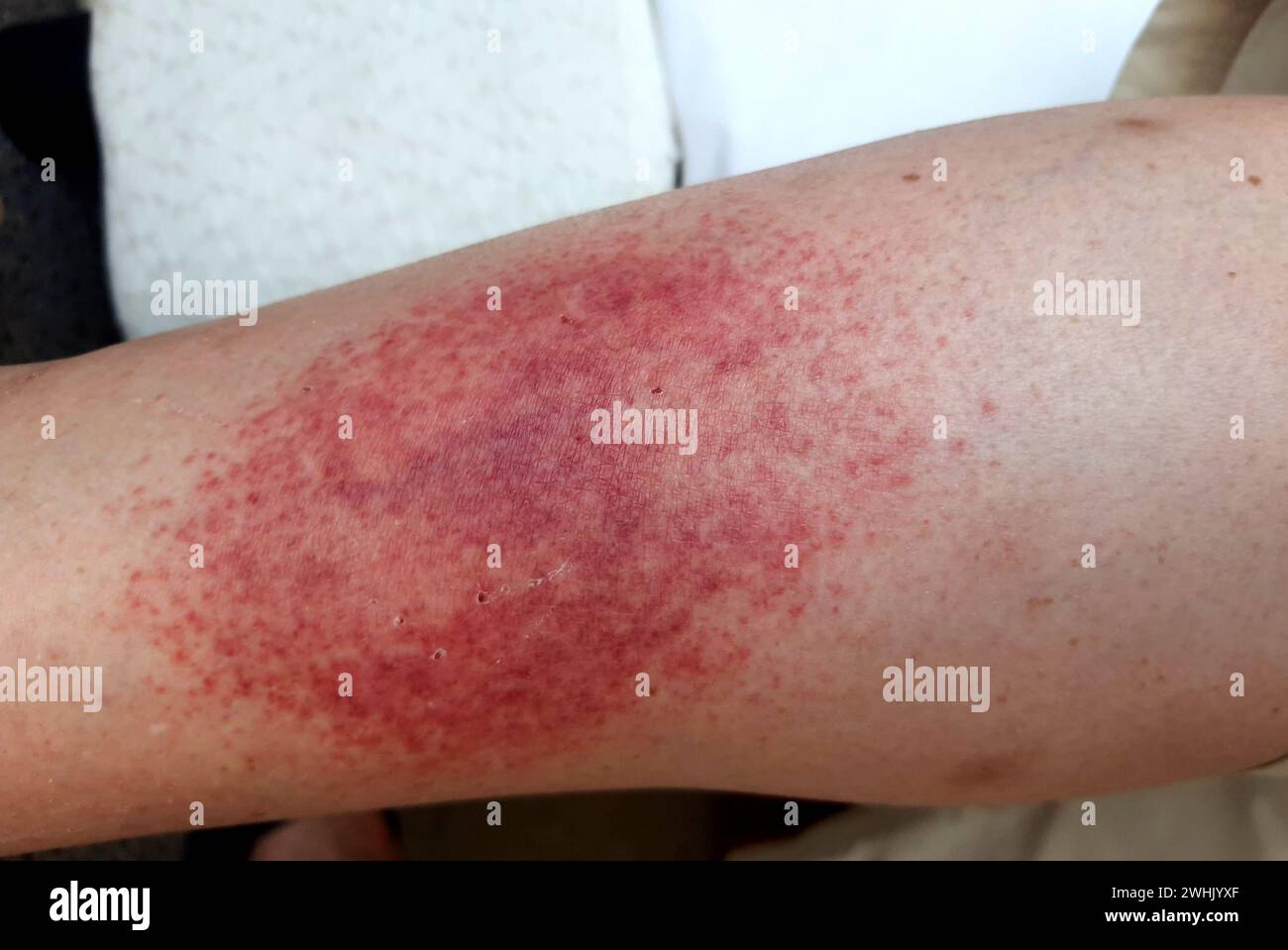 Large red burn on leg. Thermal, chemical burns, sunburn, body wound ...